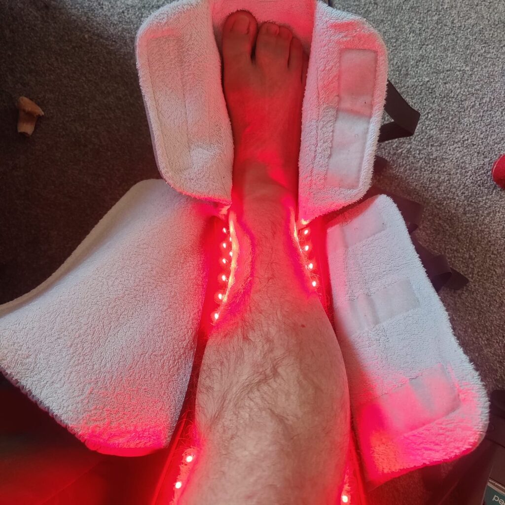 Lighting up a Ruptured Tendon – Members – Photonic Therapy Institute